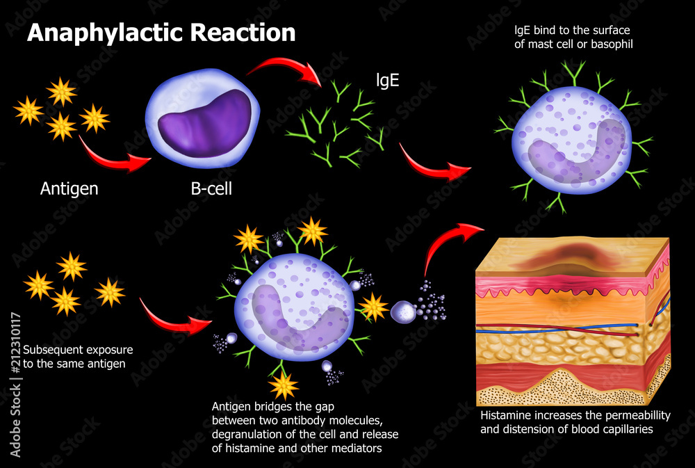Mechanism of allergy Stock Illustration | Adobe Stock