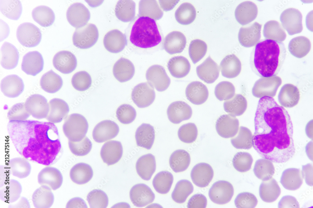 White blood cells in blood smear, analyze by microscope Stock Photo ...
