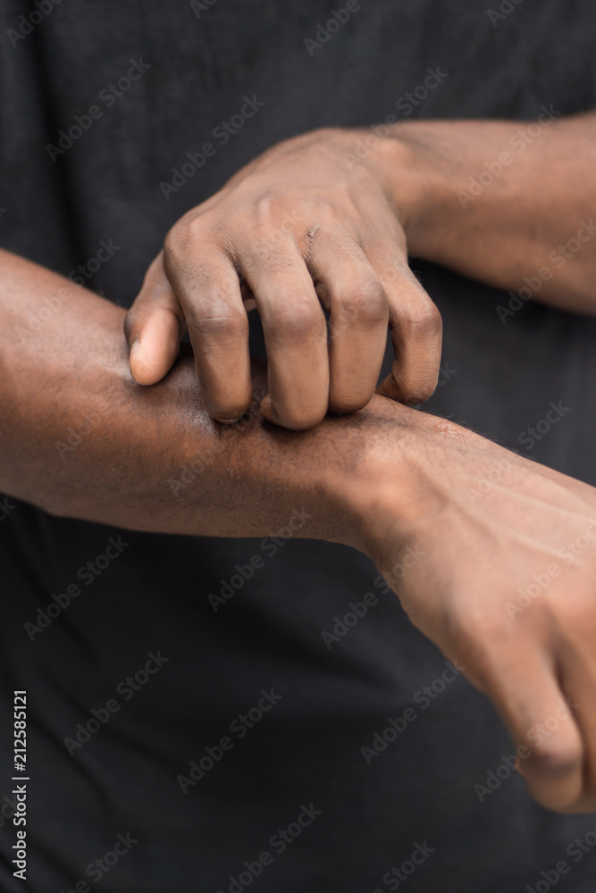 man suffering from itching skin; sick african man scratching his skin ...