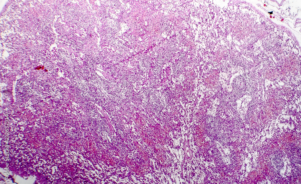 Hemorrhagic lymphadenitits, lymph node inflammation and hemorrhage ...