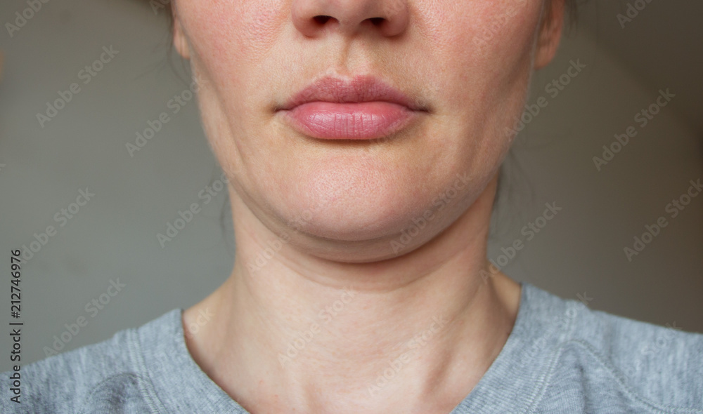 sagging chin. face line correction Stock Photo | Adobe Stock