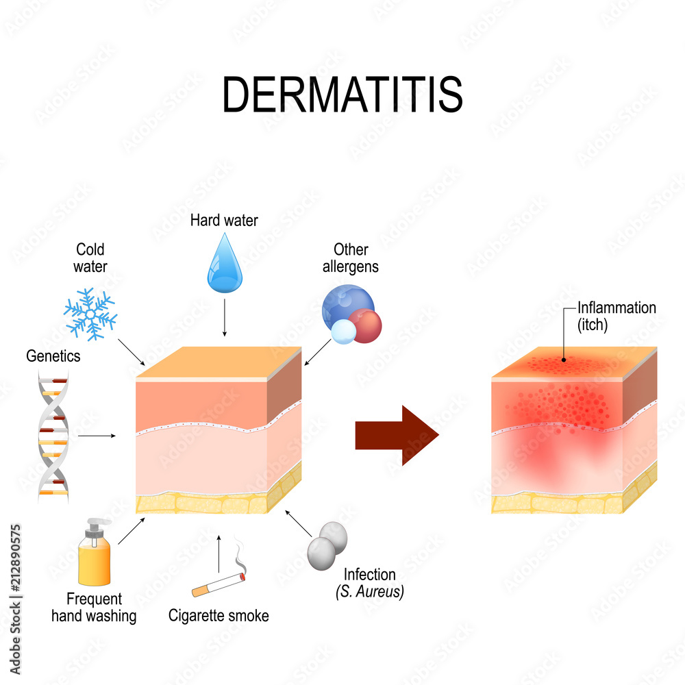 Atopic Dermatitis Atopic Eczema Factors That Cause Disease Cross