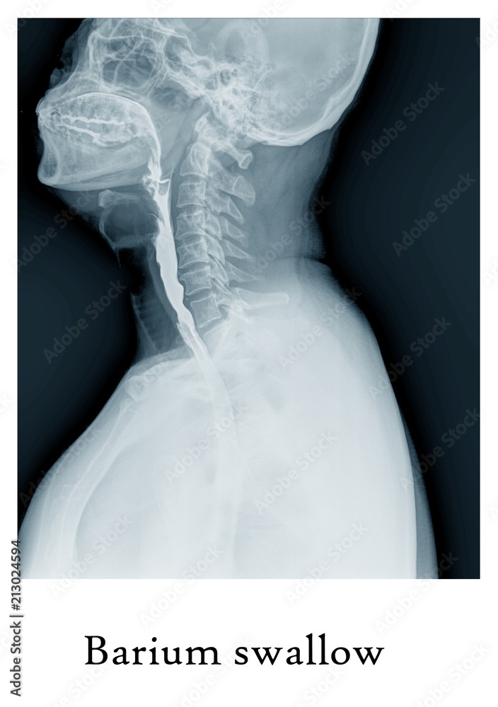Normal Barium Swallow Anatomy