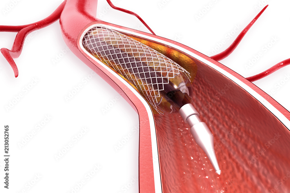 Balloon Expandable Stent. Anatomical concept Stock Illustration | Adobe ...