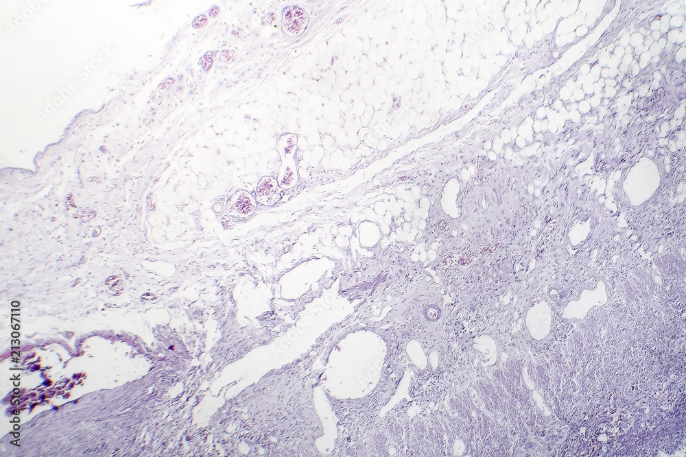 Granulomatous inflammation, light micrograph, photo under microscope ...
