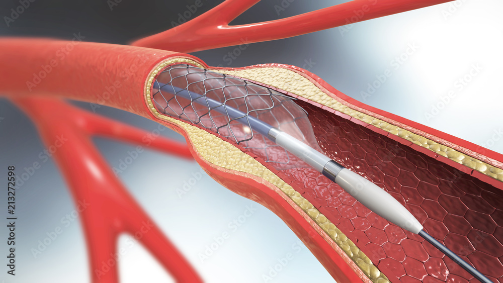 3d illustration of stent implantation for supporting blood circulation ...