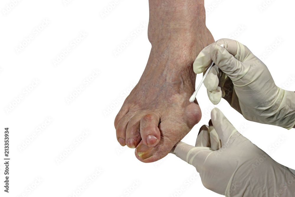 Medecin, valgus bunion, leg with deformation valgus hallux (Bunion ...