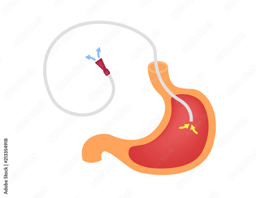 ng tube vector / nasogastric tube Stock Vector | Adobe Stock