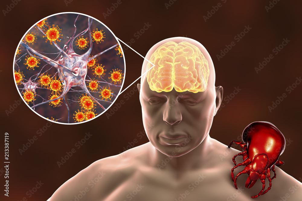 Tick-borne encephalitis concept, 3D illustration showing brain ...