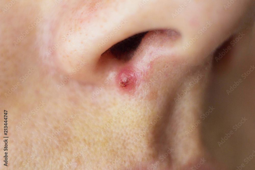 Red Bump On Nose