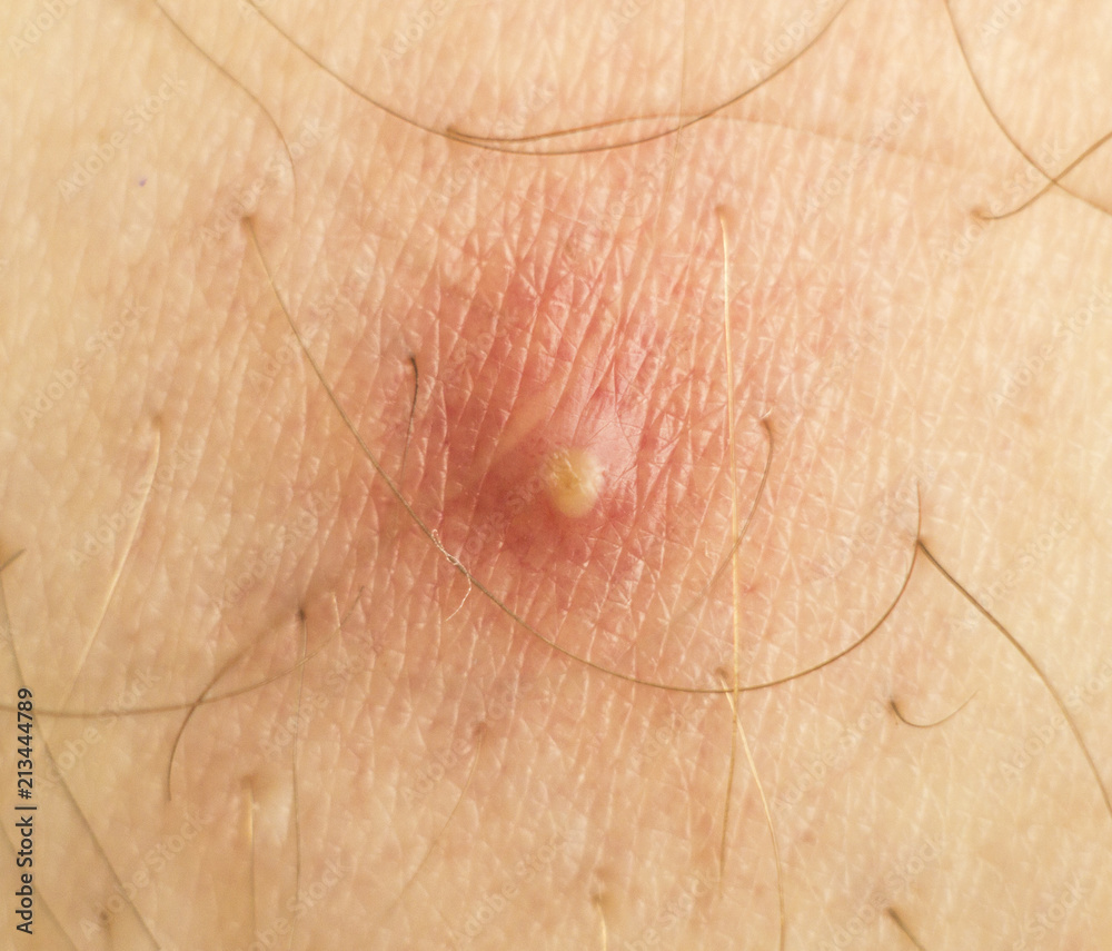 Pimples On The Foot Hotsell | www.abinandanainfra.com