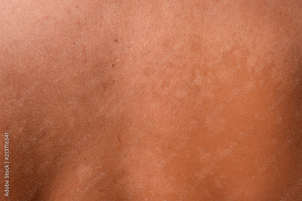 Sunburn on the skin of the back. Exfoliation, skin peels off. Dangerous ...