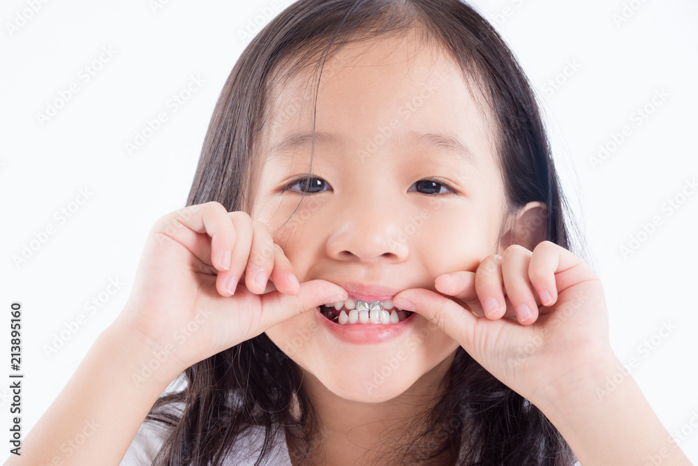 Young Asian girl child showing silver amalgam tooth sealant over white ...