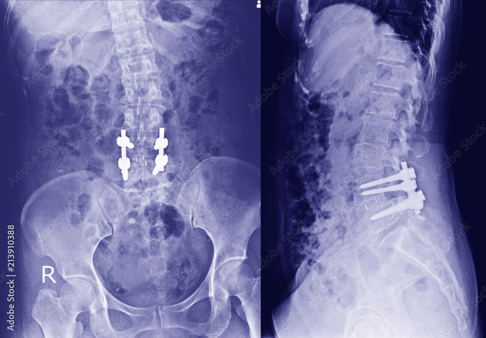 X-ray of the pelvis and spinal column ,side view Post Open Reduction ...
