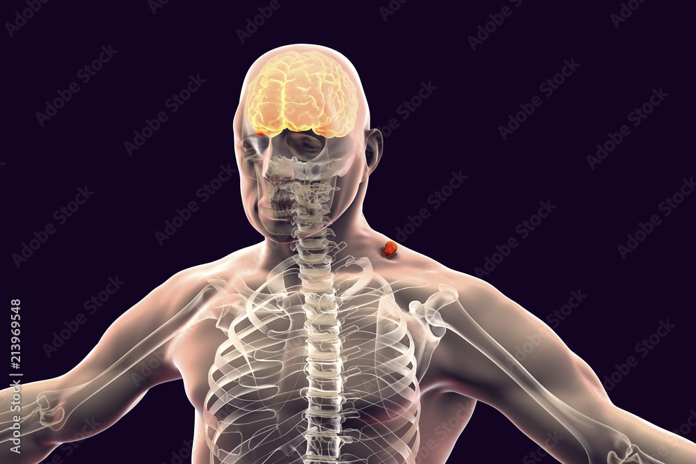 ภาพประกอบสต็อก Tick-borne encephalitis concept, 3D illustration showing ...