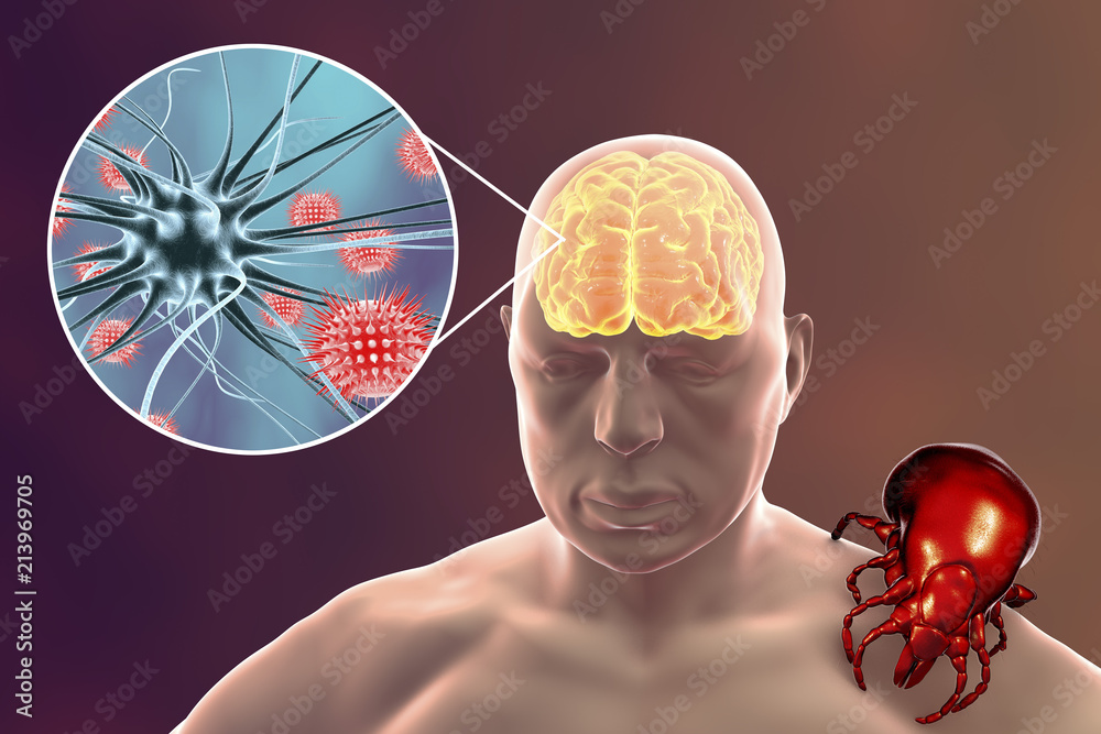 Tick-borne encephalitis concept, 3D illustration showing brain ...