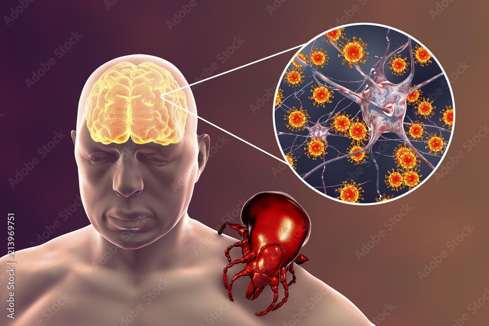 Tick-borne encephalitis concept, 3D illustration showing brain ...