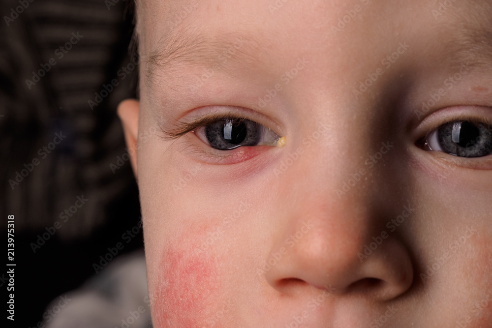 Face of little boy with red eyes inflammation (conjuctivitis) looking ...