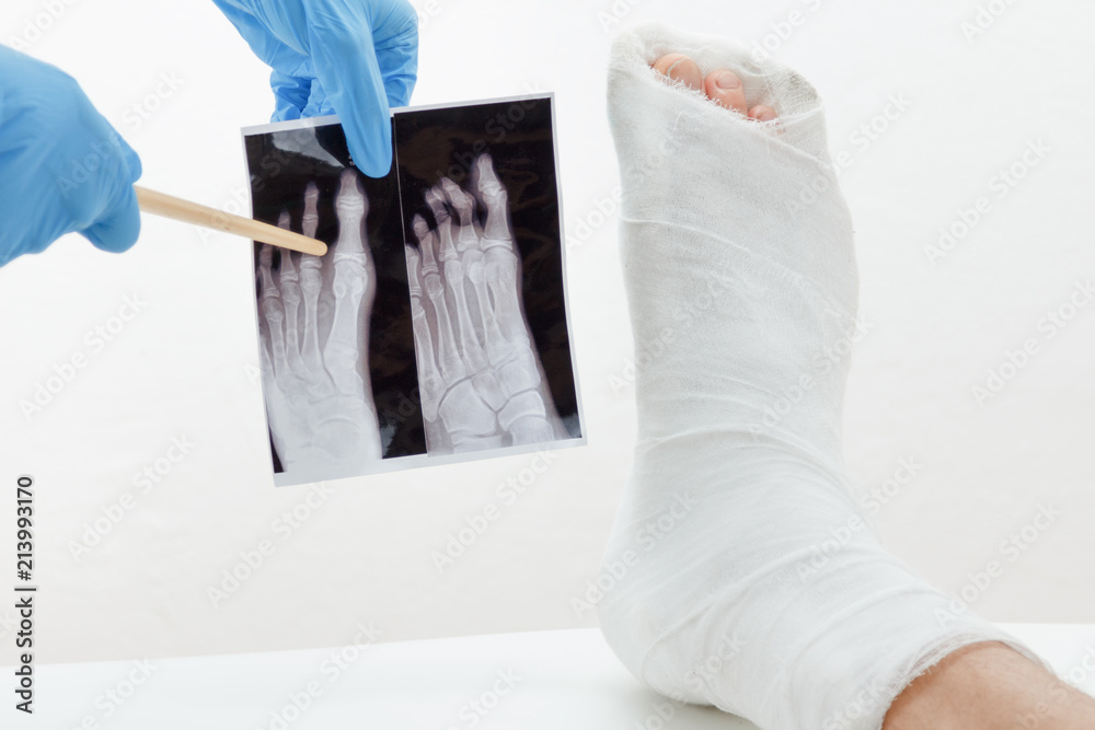 broken leg from the accident, plaster cast splint, orthopedic. Stock ...