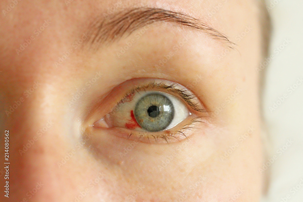 Bloodshot eye. Woman with burst blood vessel in eye. Very red bloody ...