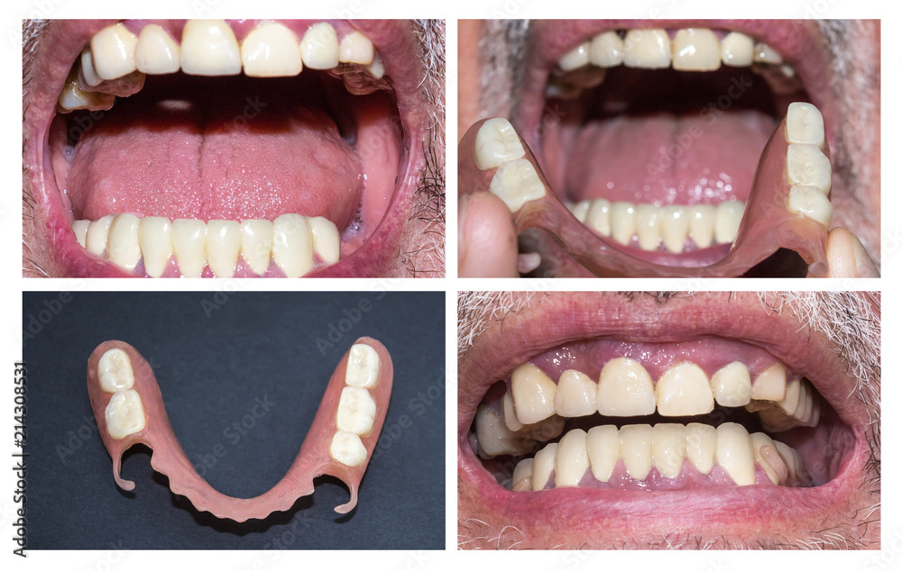Dental rehabilitation with upper and lower prosthesis, before and after ...