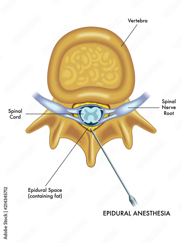 Vector illustration of a medical anesthesia method called epidural ...