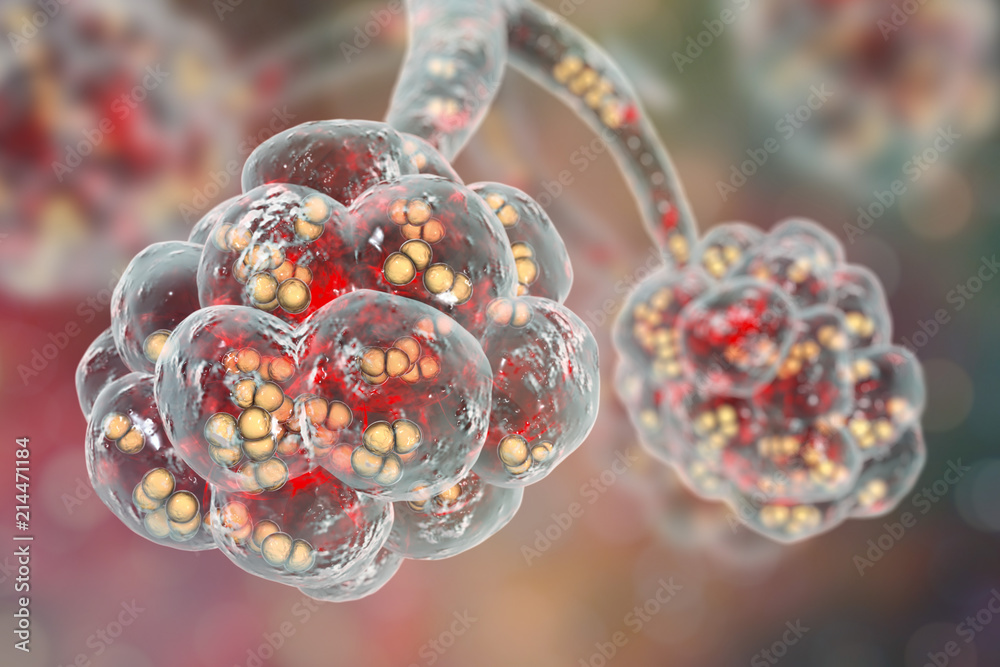Pneumococcal pneumonia, medical concept. 3D illustration showing ...