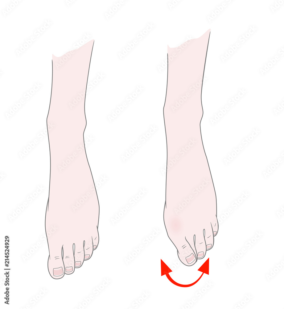 Foot massage. Bunion. Hallux valgus or bunion formation of the foot ...