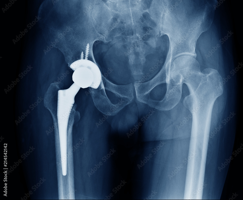X-ray scan image of hip joints with orthopedic hip joint replacement or ...