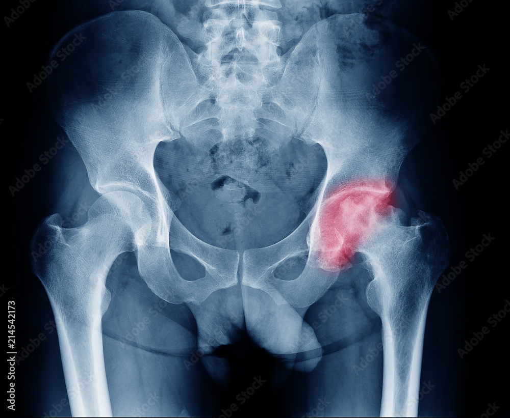 X-ray image of painful hip in man present Osteoarthritis left hip joint ...