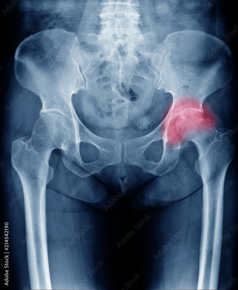Osteoarthritis X Ray Hip