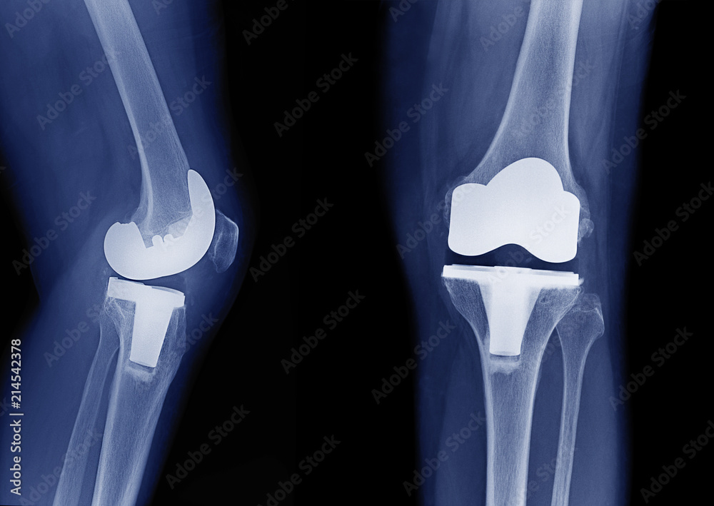 x-ray image of total knee arthroplasty / total knee replacement side ...