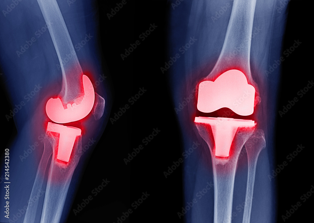 x-ray image of total knee arthroplasty / total knee replacement side ...