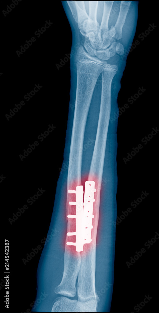 X-ray image of adult forearm show fracture at ulnar and radius fix by ...