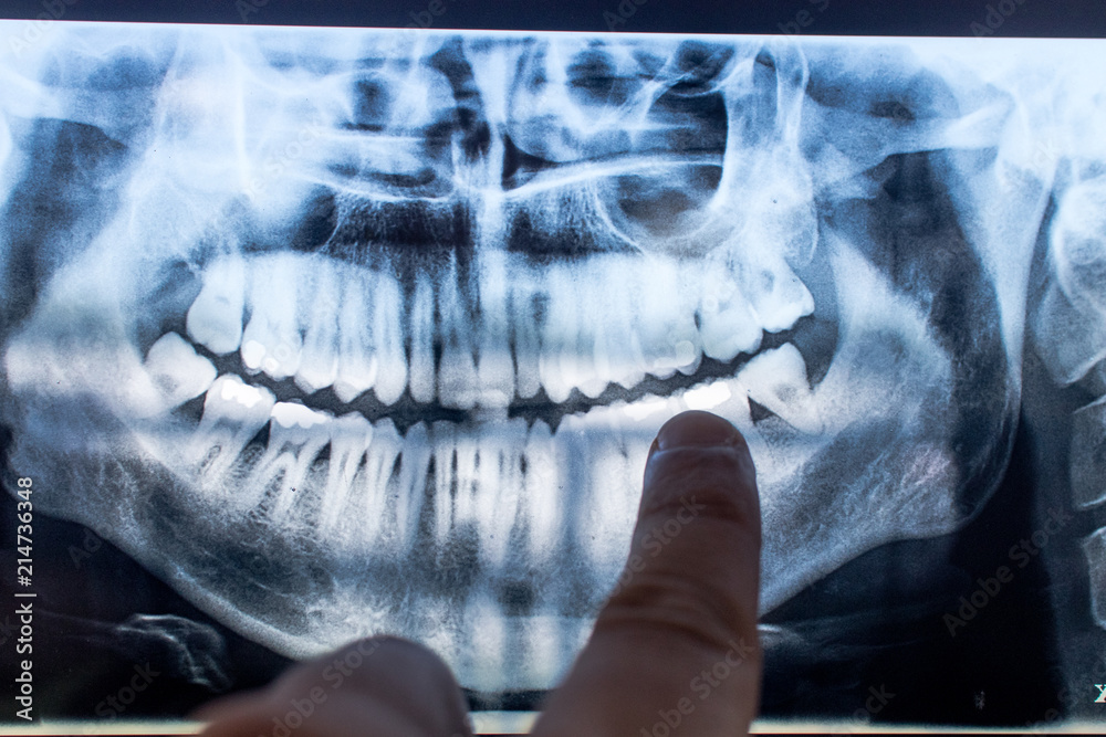 X-ray of a mouth with all visible teeth and cavity in evidence ...