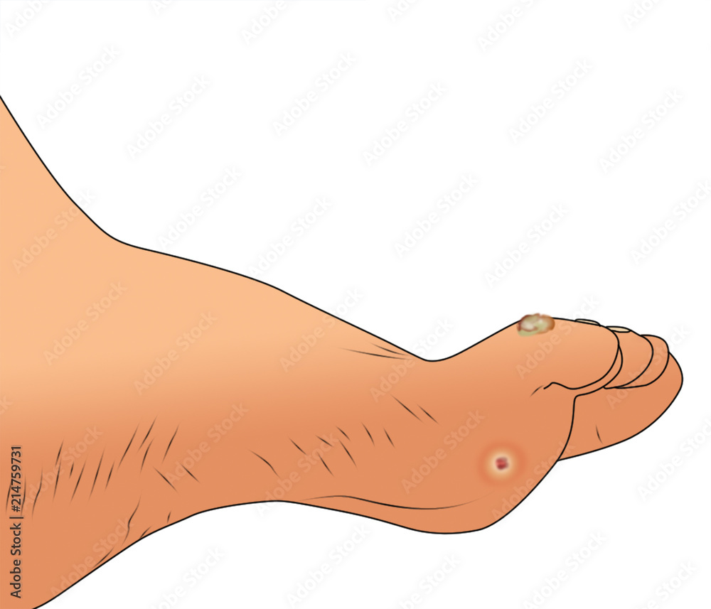 Corns and Calluses Stock Illustration | Adobe Stock