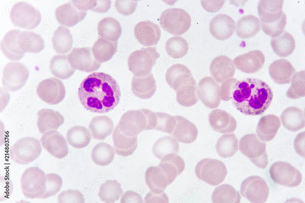 White blood cells in blood smear, analyze by microscope Stock Photo ...