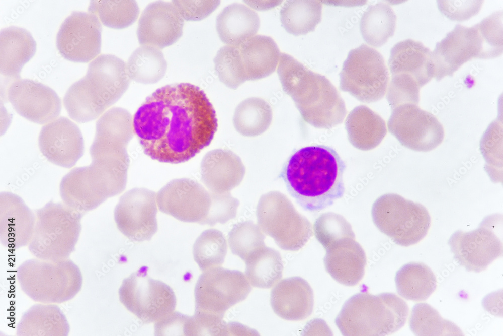 White blood cells in blood smear, analyze by microscope Stock Photo ...