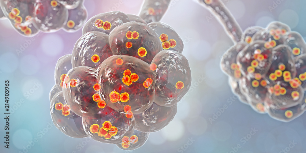 Staphylococcal pneumonia, medical concept. 3D illustration showing ...