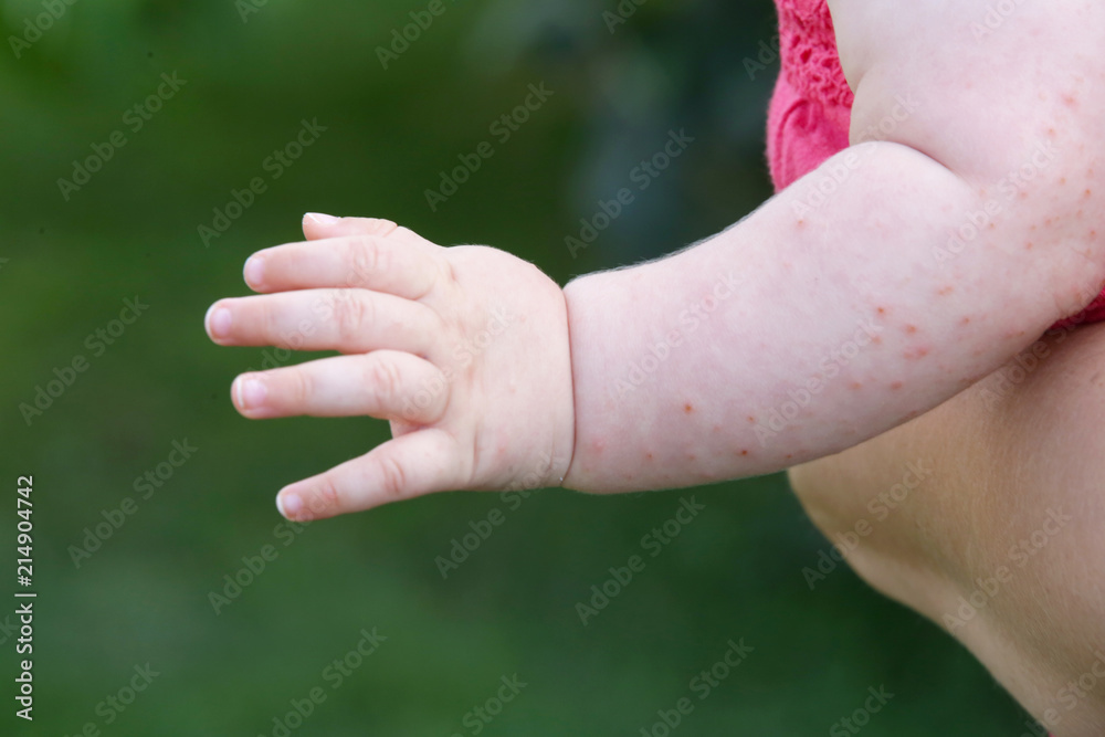 Baby rash caused by fever, insect bite, skin allergy or heat reaction ...