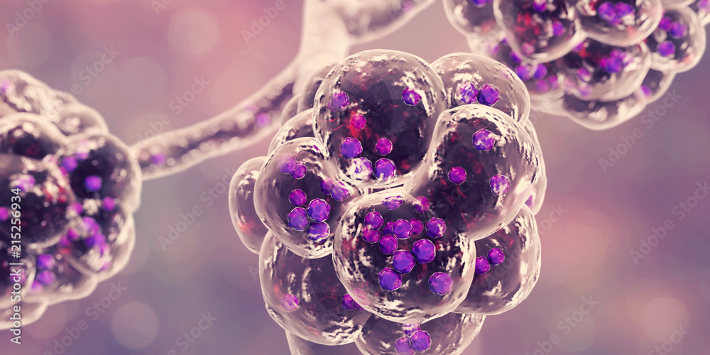Staphylococcal pneumonia, medical concept. 3D illustration showing ...