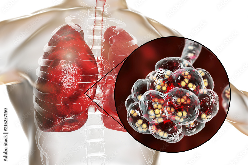 Pneumococcal pneumonia, medical concept. 3D illustration showing ...