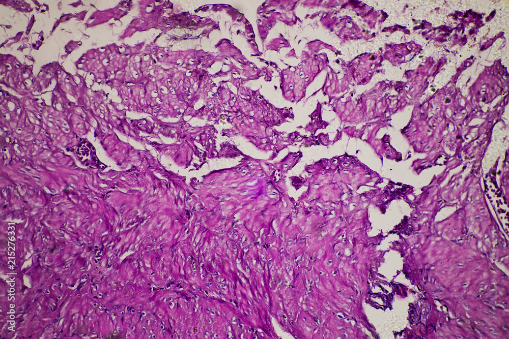 human stomach gastric mucosa intestinal metaplasia Stock Photo | Adobe ...