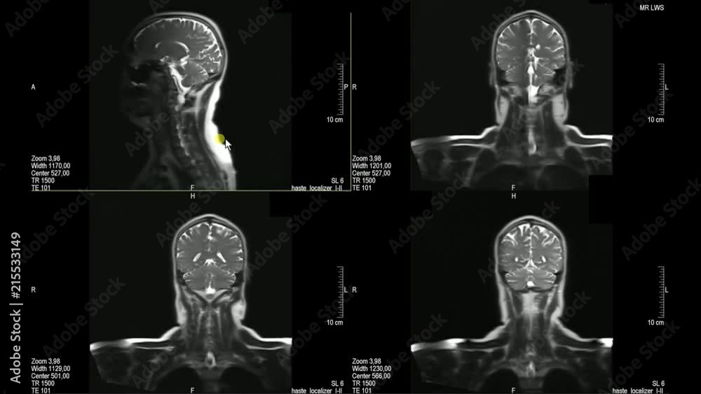 Real MRI Scan of Doctor examining brain and thoracic spine Stock Video ...