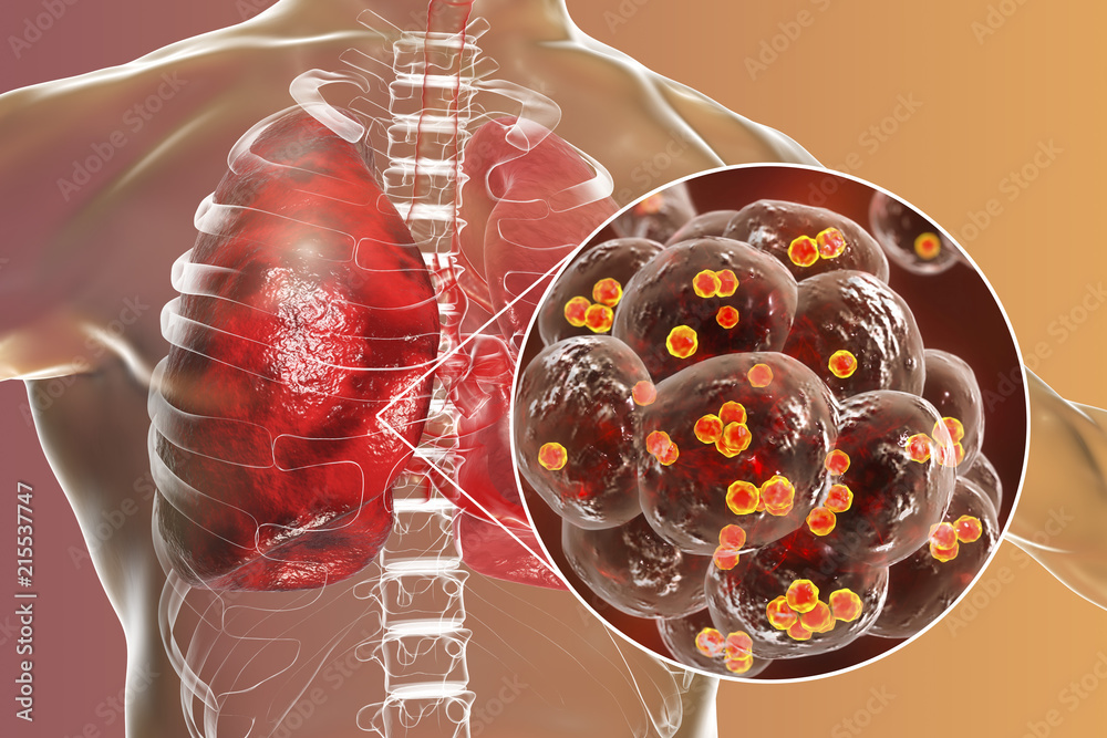 Staphylococcal pneumonia, medical concept. 3D illustration showing ...