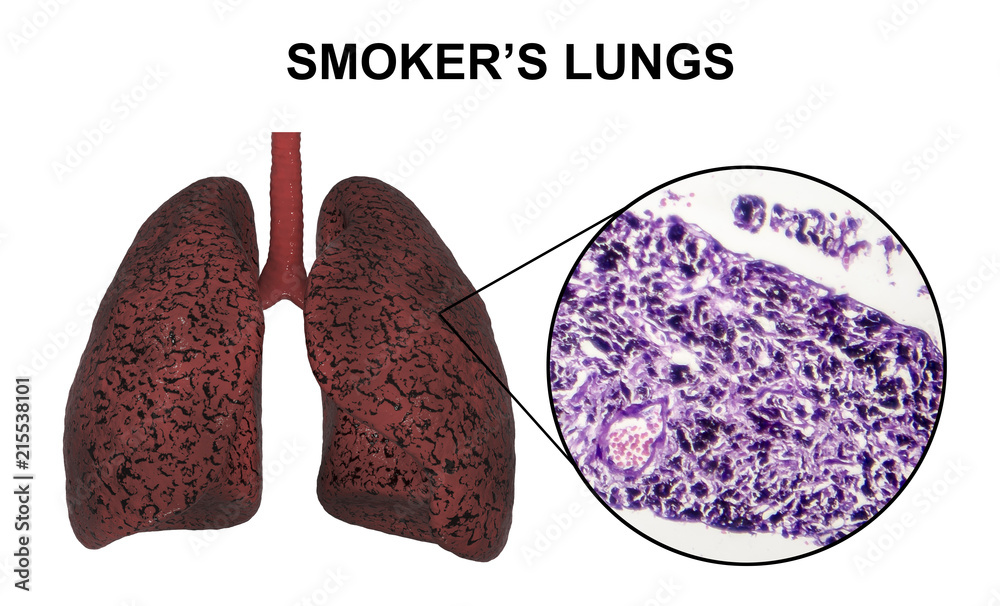Smoker's lungs, 3D illustration and light micrograph, photo under ...
