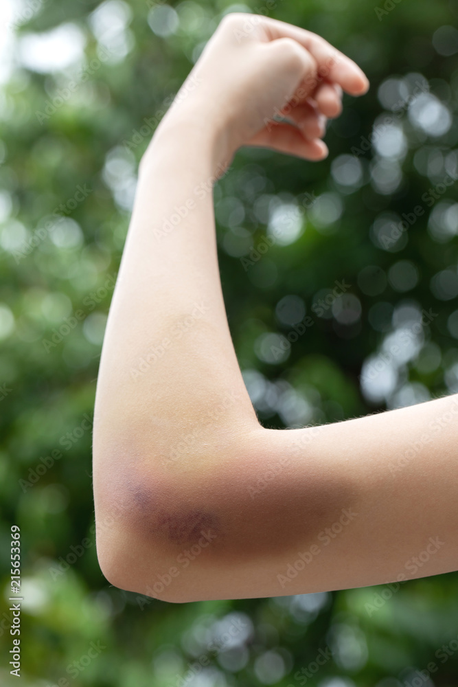 A teenager girl show a big purple bruise on her left arm that is caused ...