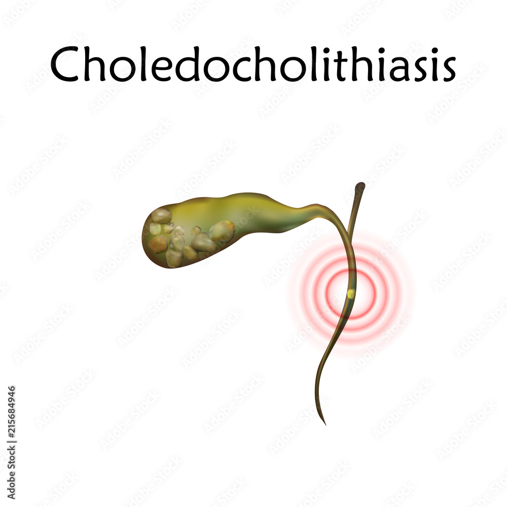Gallbladder disease, inflammation, gallstone blocks common bile duct ...