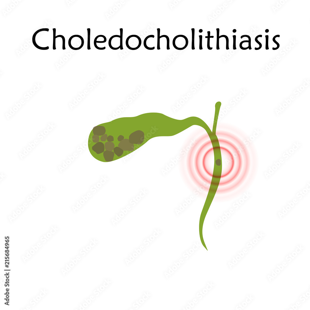 Gallbladder disease, inflammation, gallstone blocks common bile duct ...
