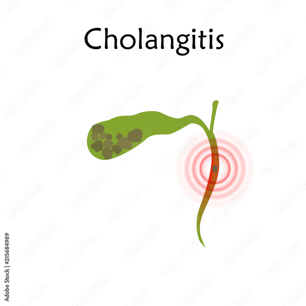 Gallbladder disease, inflammation, gallstone blocks common bile duct. Cholangitis. Anatomy ...